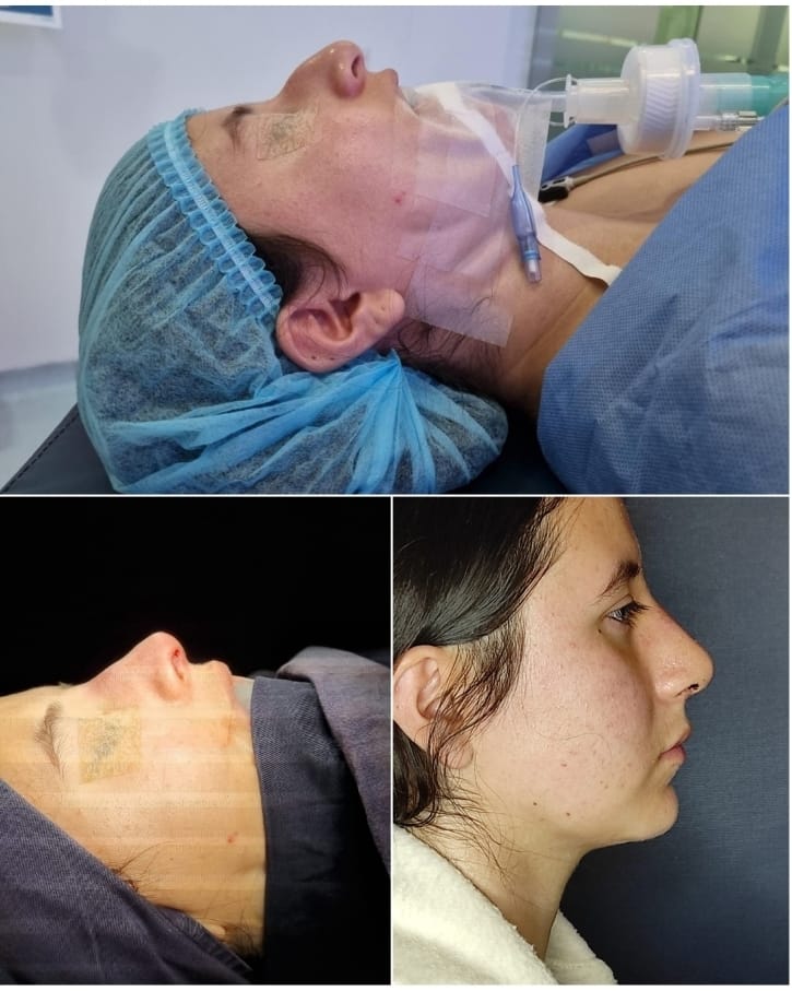 Cirugia de las orejas / Otoplastia – Dr Jose Luis Gomez